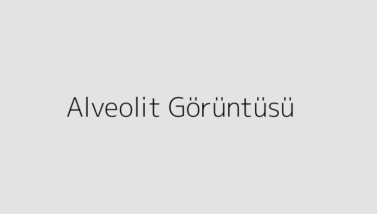 Alveolit Görüntüsü - Teknoloji Doktoru